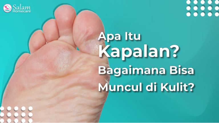 Apa Itu Kapalan? Bagaimana Bisa Muncul di Kulit? - Salam Homecare