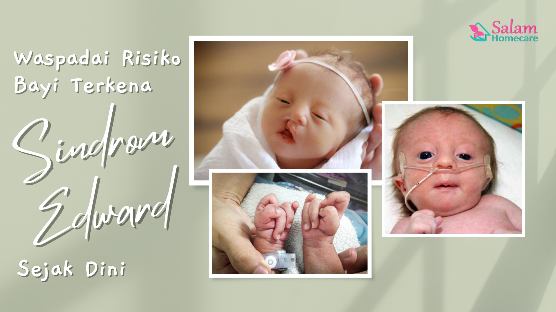 Deteksi Sindrom Edward Pada Bayi Sejak Dini - Salam Homecare