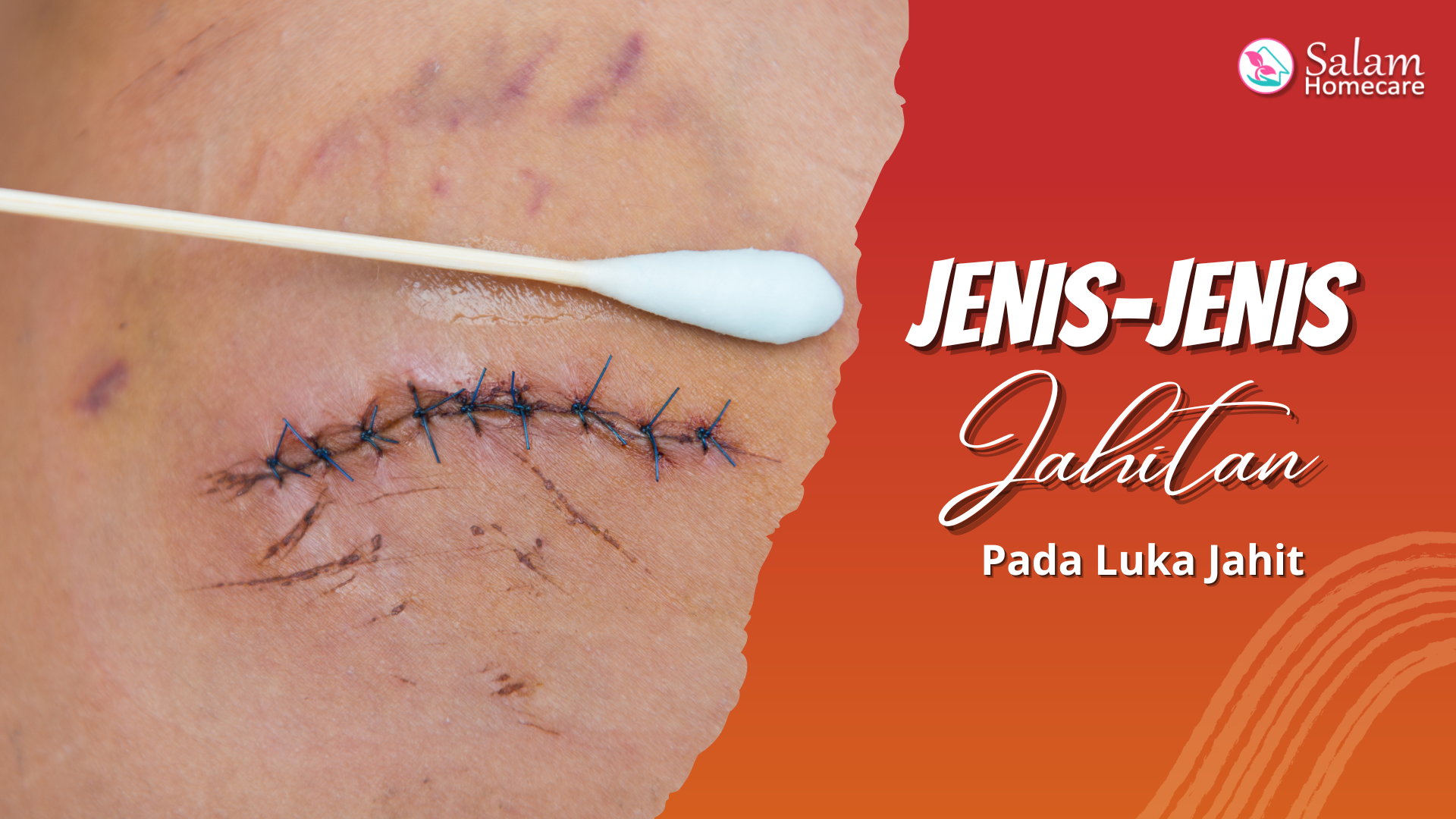 Jenis-jenis Jahitan pada Luka Jahit - Salam Homecare
